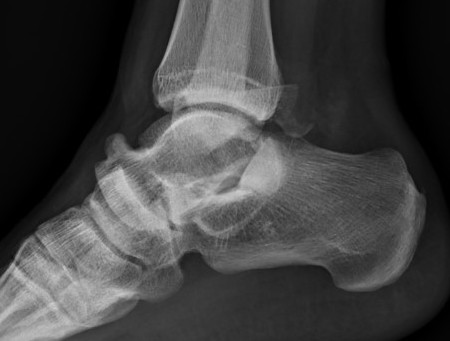 Subtalar Dislocation | The Bone School